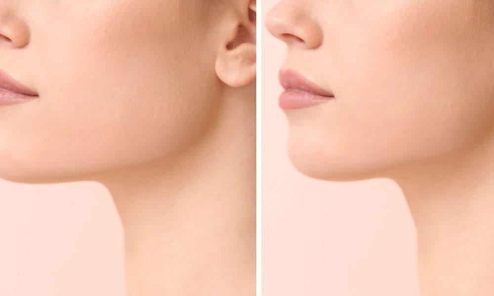 What is a Better Option For Chin enhancement, Bio-stimulator or ...